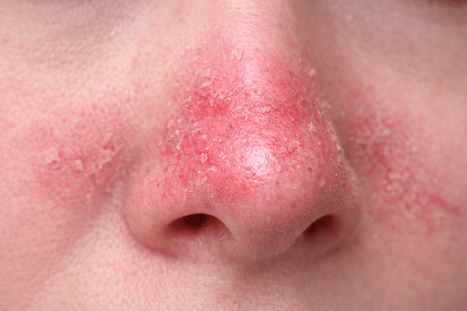 Redness of the nose is seen unexpectedly! What are the causes and ...
