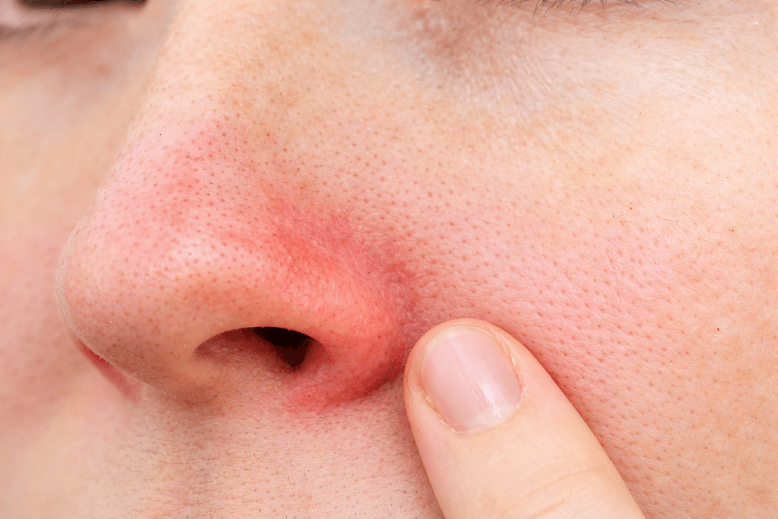 Redness of the nose is seen unexpectedly! What are the causes and ...